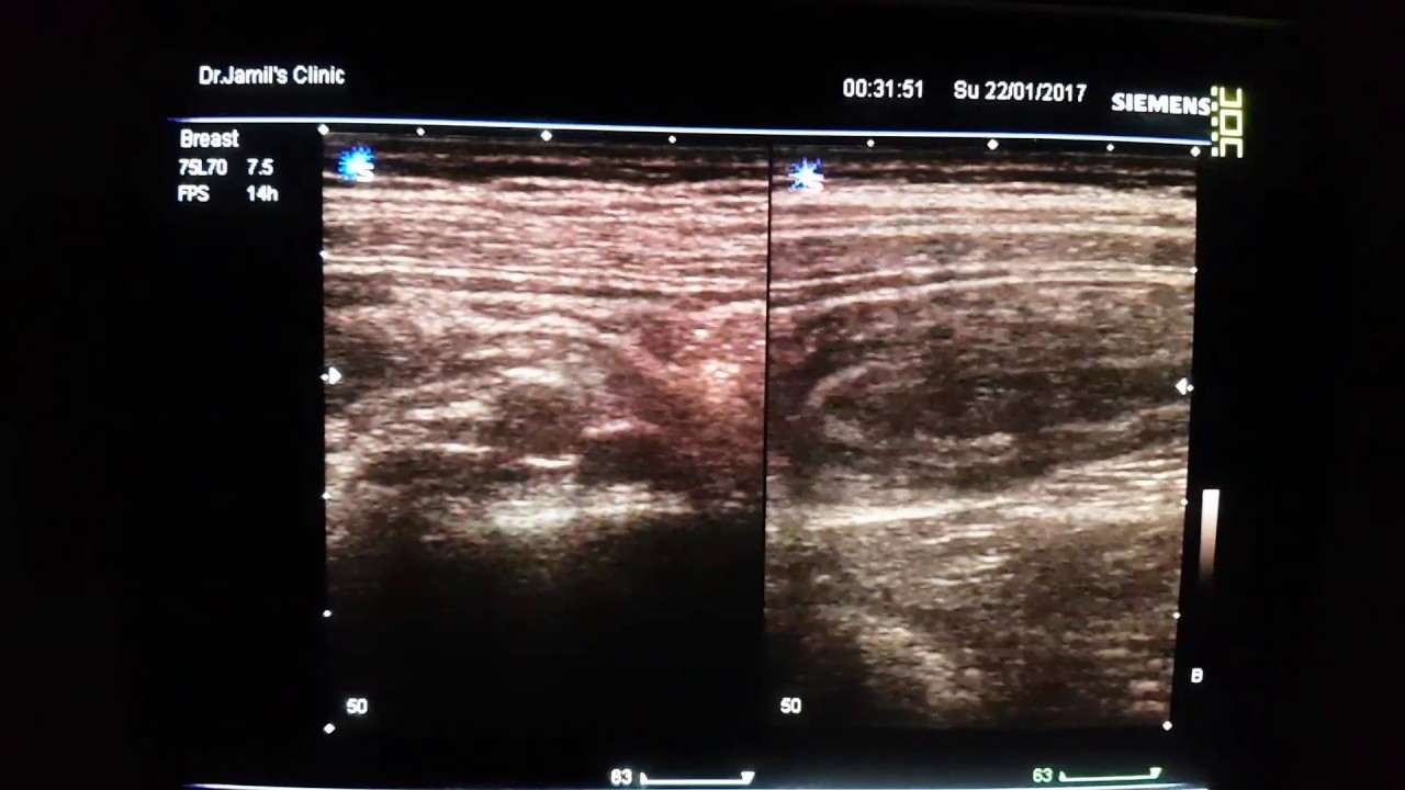 Retrocecal Appendicitis - YouTube