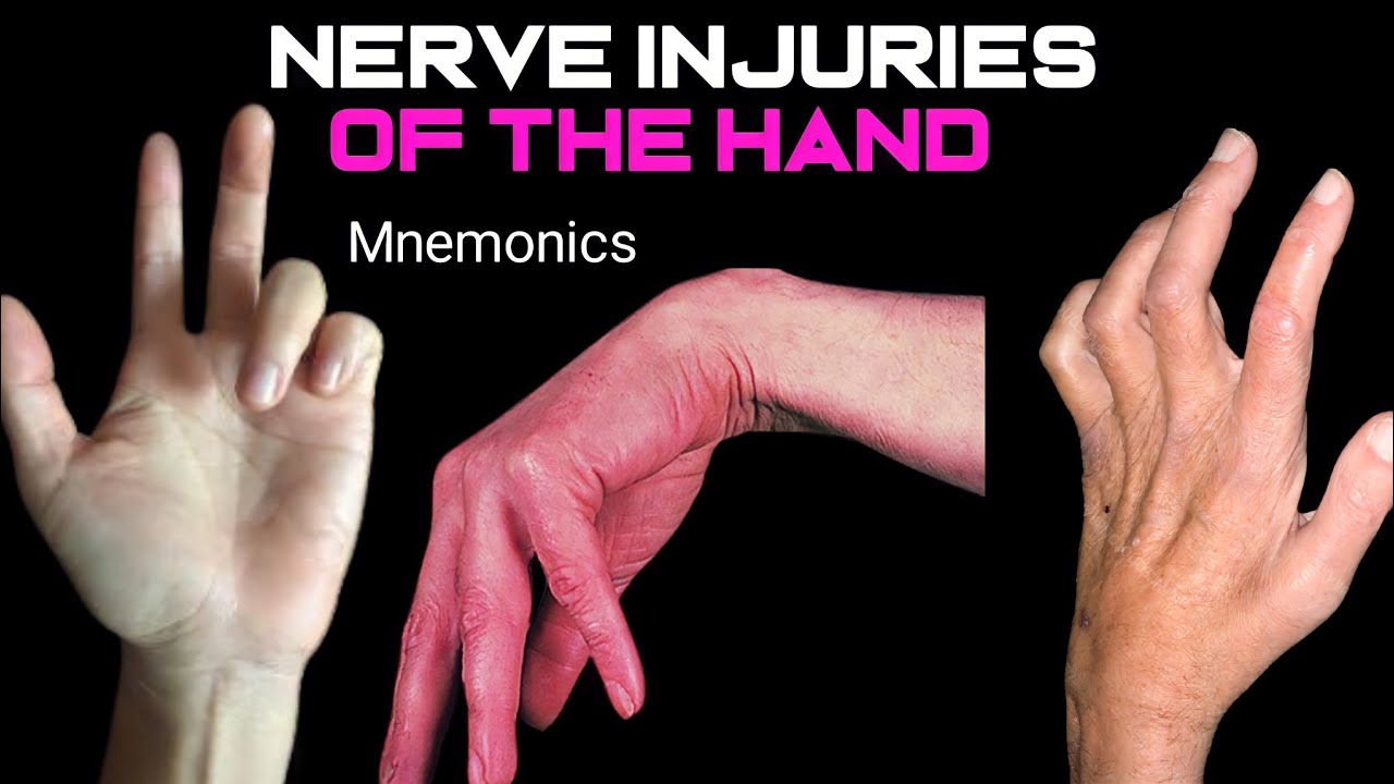 Claw Hand Wrist Drop Ape Hand In Urdu And Hindi Nerves Injuries Of The claw-hand-wrist-drop-ape-hand-in-urdu-and-hindi-nerves-injuries-of-the