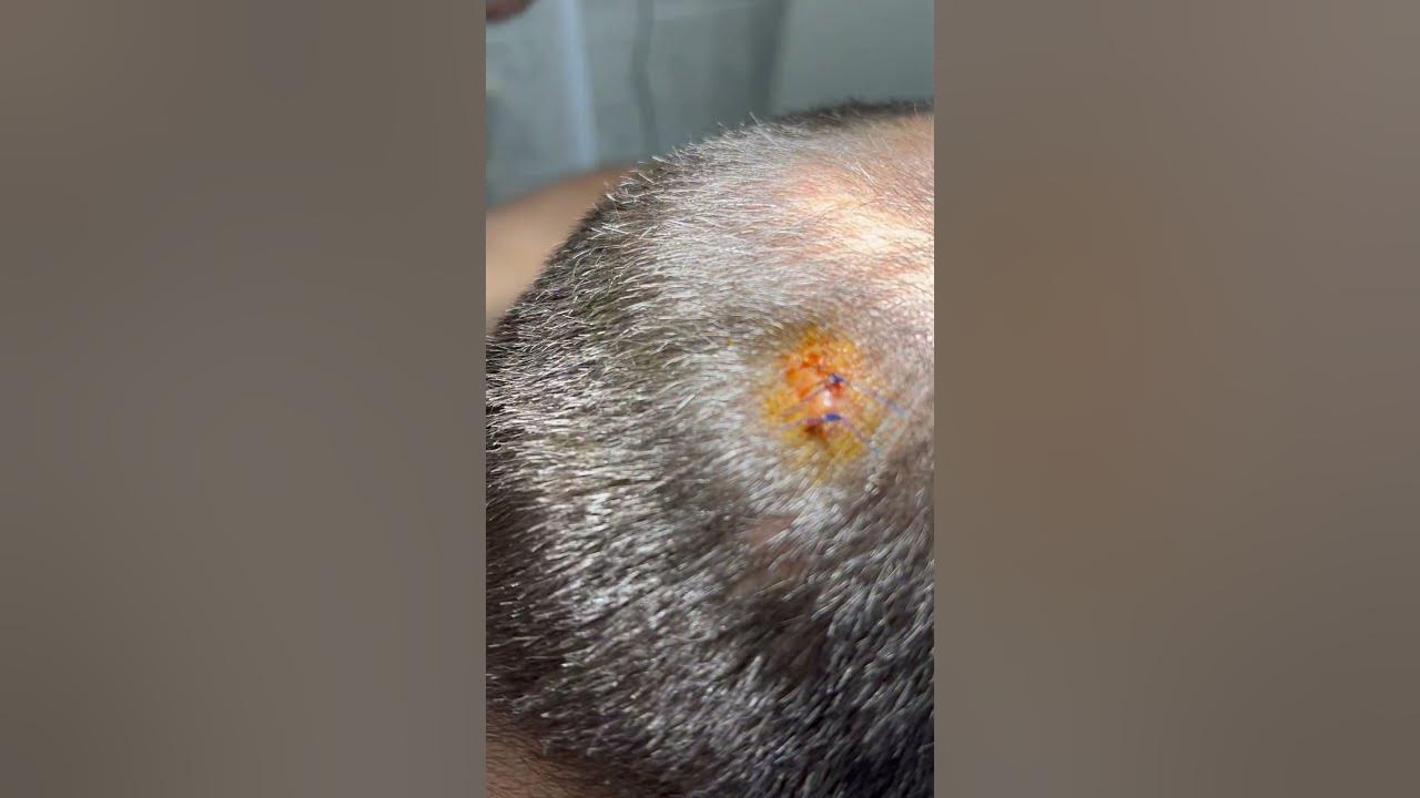 Снятие швов после удаления атеромы на голове и наложение повязки, не ...