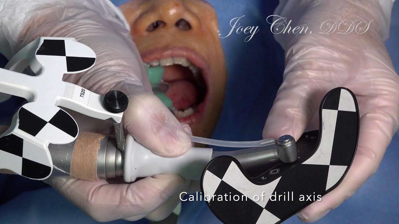 Navident Navigation System with Osseodensification - YouTube