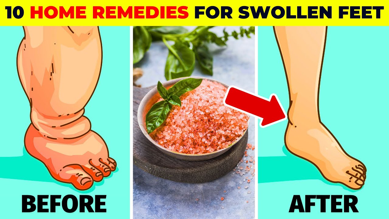 10 POWERFUL Home Remedies to Relieve Swollen Ankles and Feet FAST - YouTube