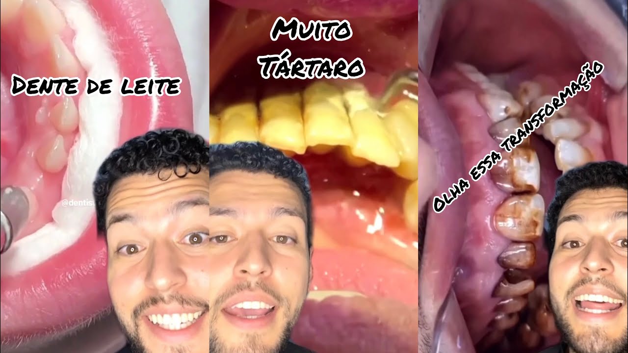Dentes moles/Muito Tártaro/Olha essa linda transformação - YouTube