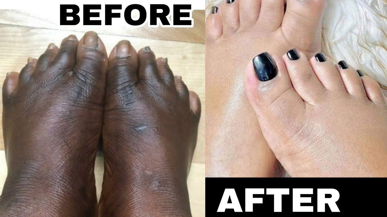 3 WAYS / ON HOW TO GET BRIGHTER LEG & HAND GET RID OF DARK KNUCKLES ON ...