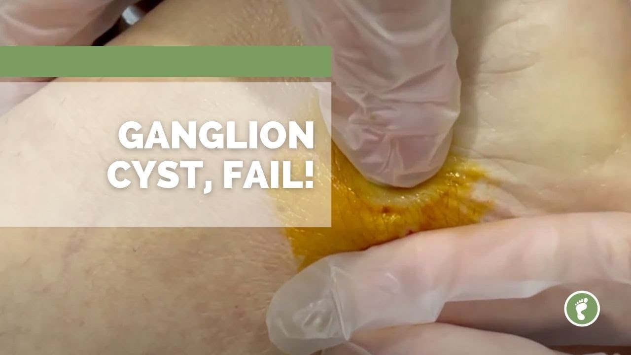 DEEP POPPING CYST 💥 - YouTube