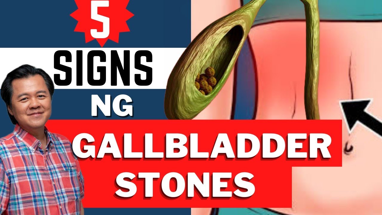 5 Warning Signs ng Gallbladder Stones na Hindi Mo Alam - Payo ni Doc ...