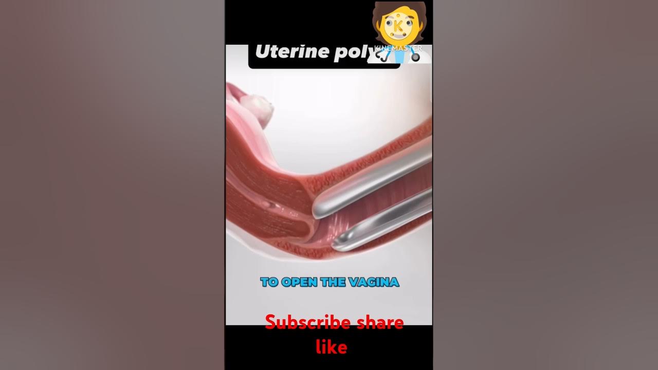 How to remove uterus polyps - YouTube