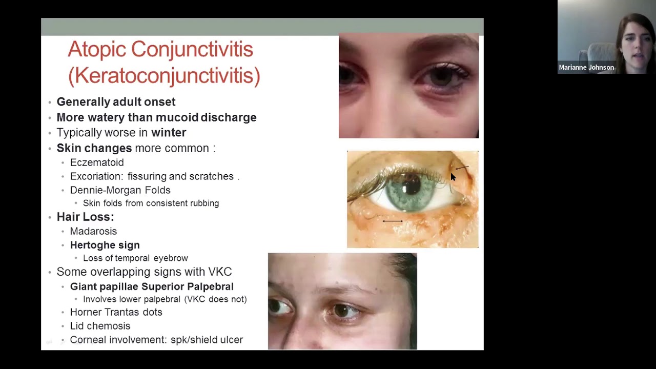 Atopic Conjunctivitis