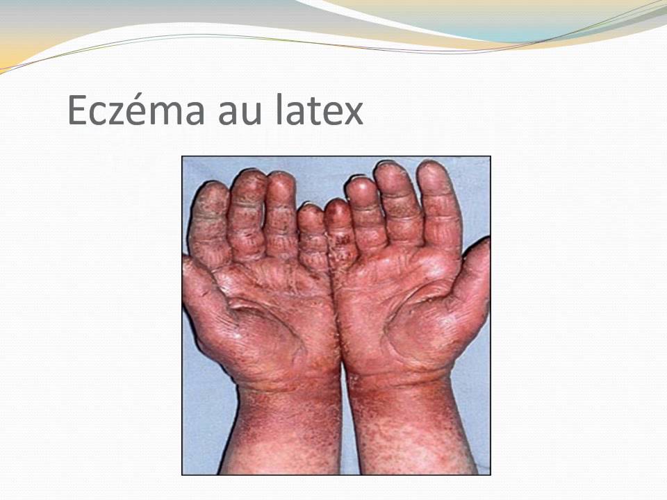 MEDECINE DU TRAVAIL Conduite à tenir devant une dermatose ...