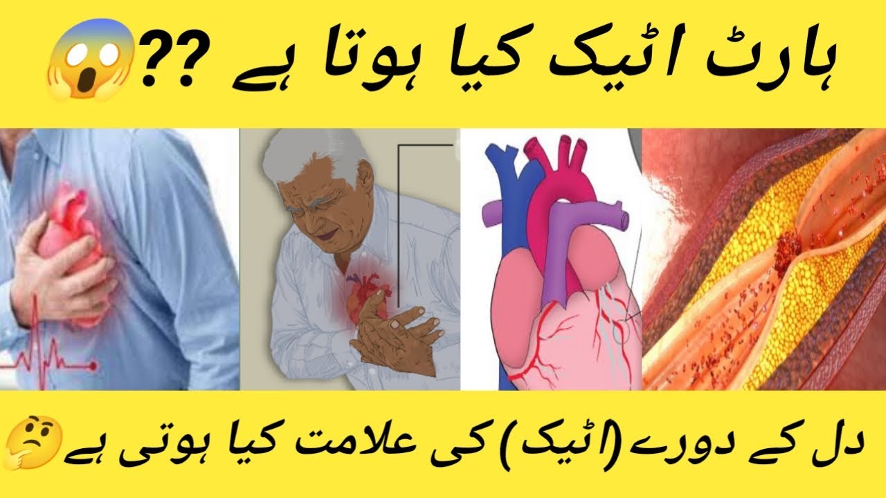 Stable and Unstable Angina | Myocardial Infarction | Coronary Vessels ...
