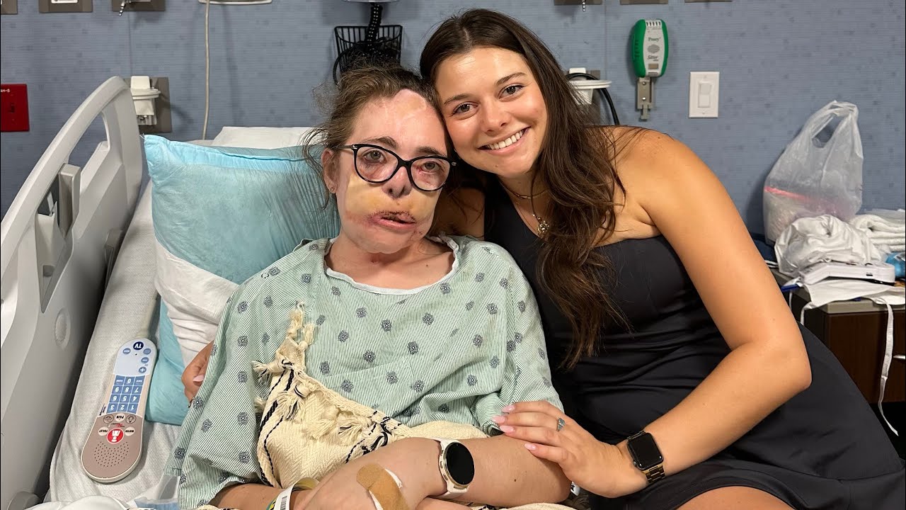 20th Surgery Upper Lip Debulking & Chin Shaping - YouTube