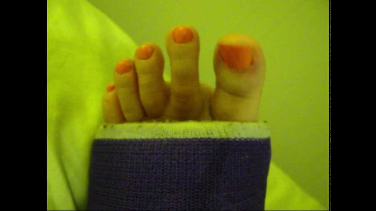 Playful Neon Orange Toes in Leg Cast - YouTube