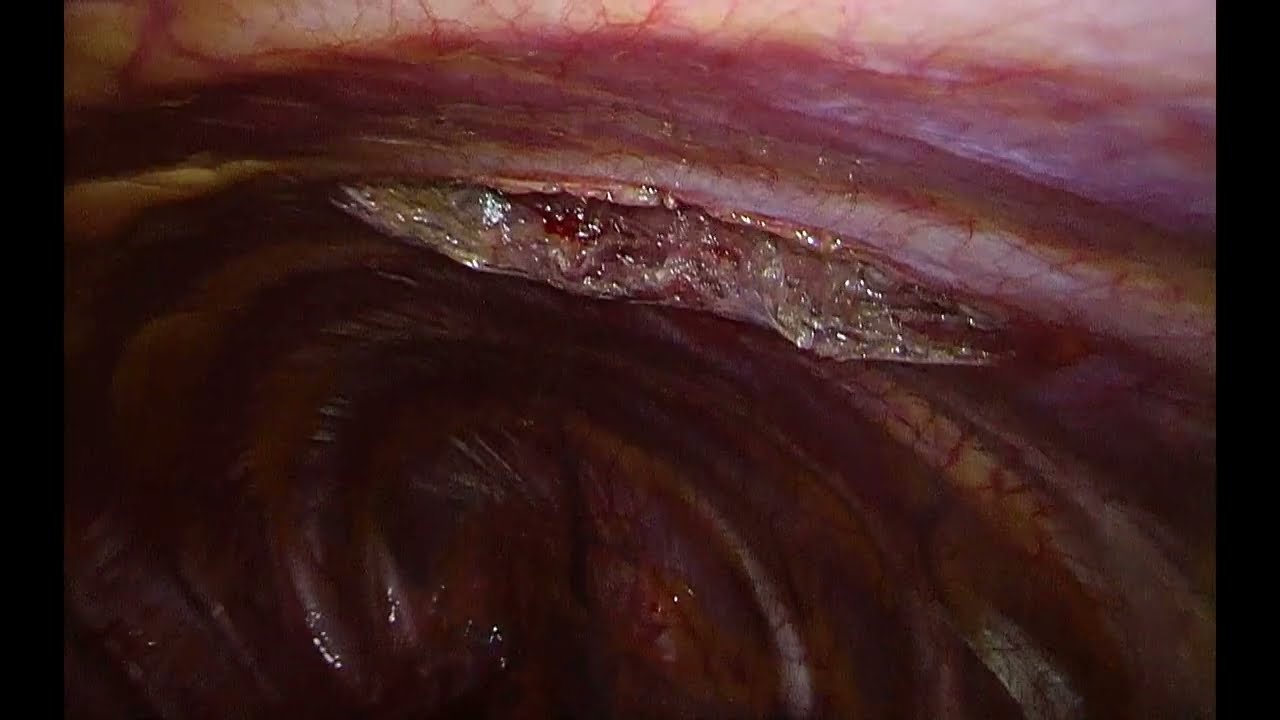 Bullectomy - VATS - Giant Bulla P3 - YouTube