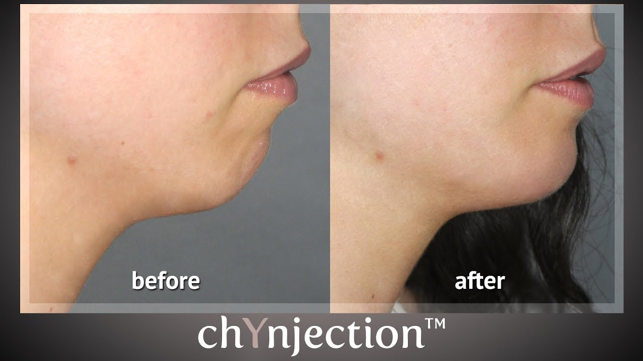 chYnjection™ by Dr. Yan Trokel - YouTube