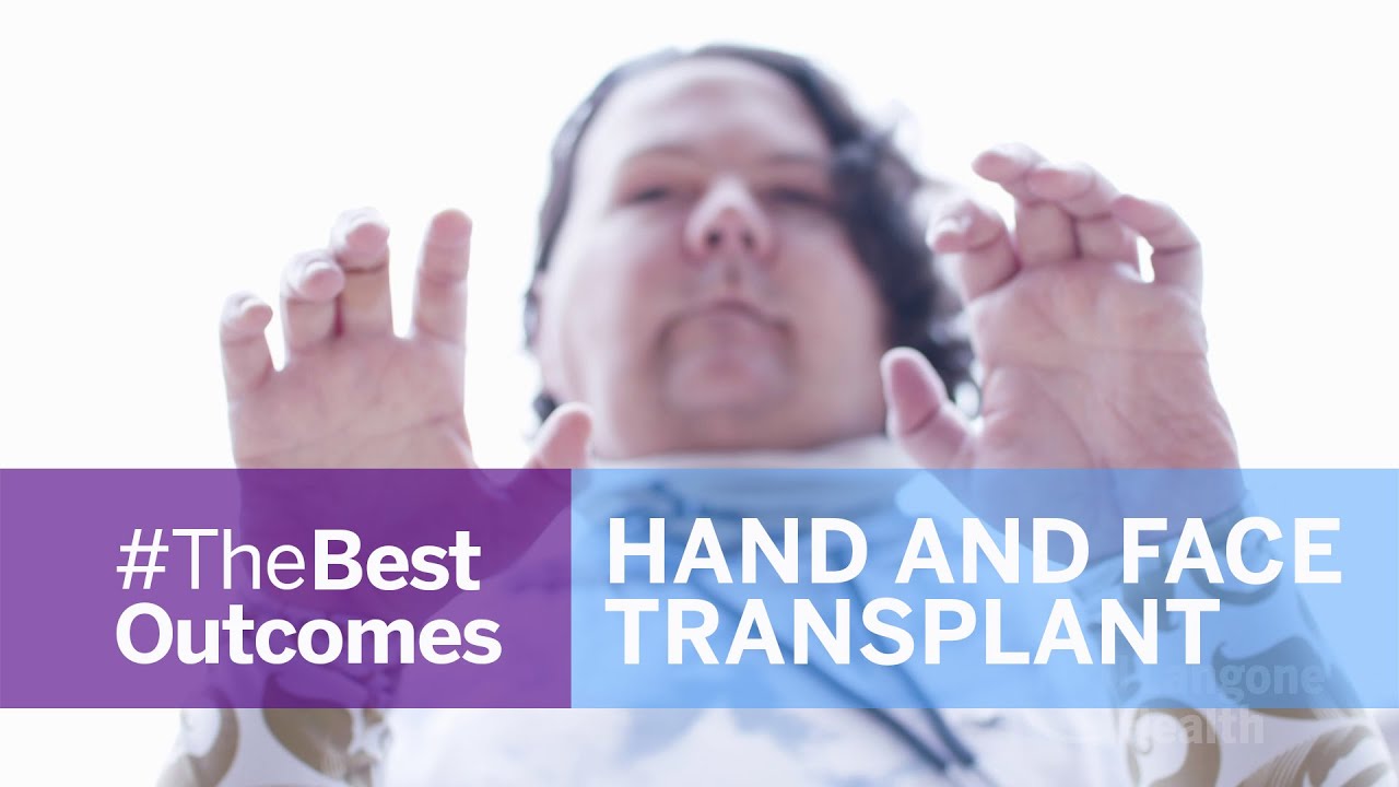 Face and Double Hand Transplant Journey: Joe Dimeo's Story - YouTube