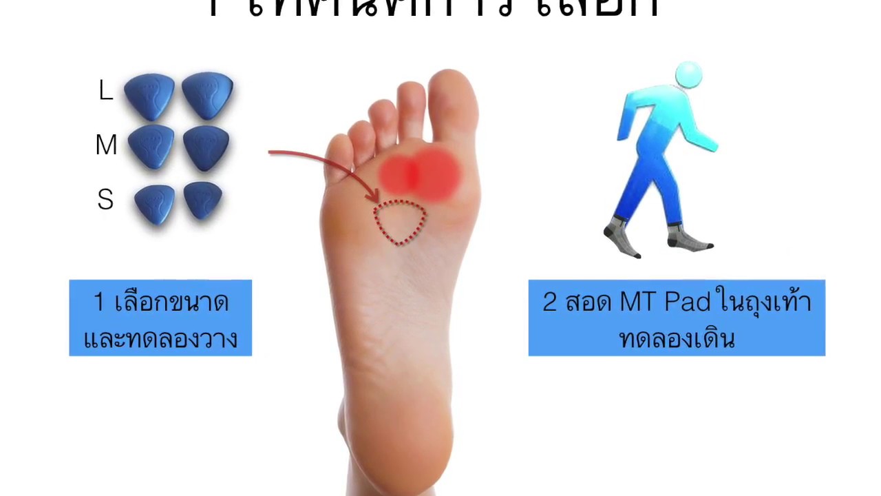 การใช้อุปกรณ์เสริม MT pad สำหรับเจ็บจมูกเท้า และ อุ้งเท้าสูง - YouTube