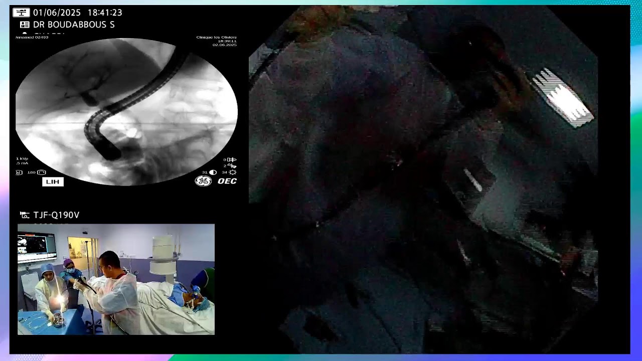 ERCP for acute cholangitis - YouTube