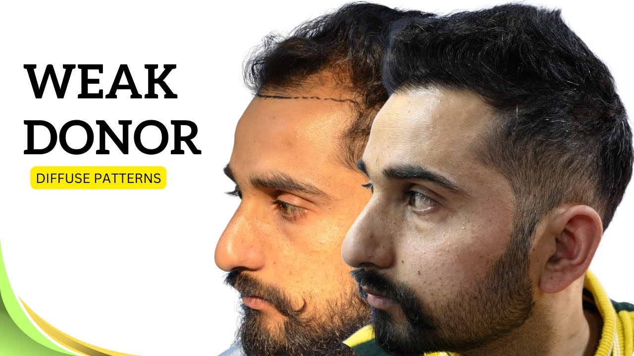 Hair Transplant in India for Diffuse Pattern Alopecia - YouTube