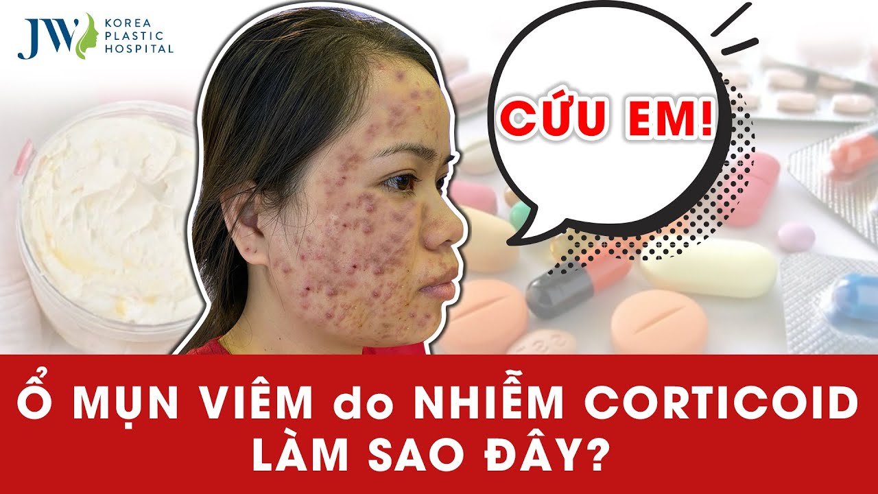 PHÁT HOẢNG làn da NHIỄM CORTICOID, Ổ MỤN VIÊM chi chít mặt XÌ DỊCH MỦ ...