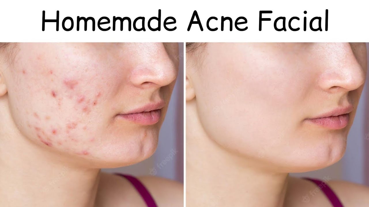 Homemade Acne Facial for oil skin and also gives you a glow in days👍 ...