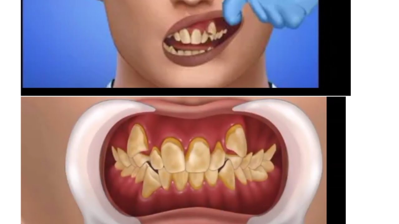 ASMR Amazing Braces Animation/Remove Tooth decay - YouTube