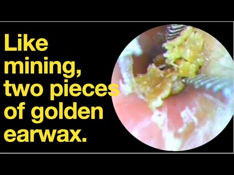 Like mining, two pieces of golden earwax.|ear wax removal | ear ...