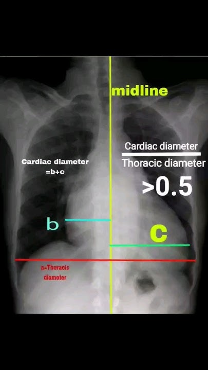 Cardiomegaly|| chest x-ray|| Right ventricular enlargement||Left ...