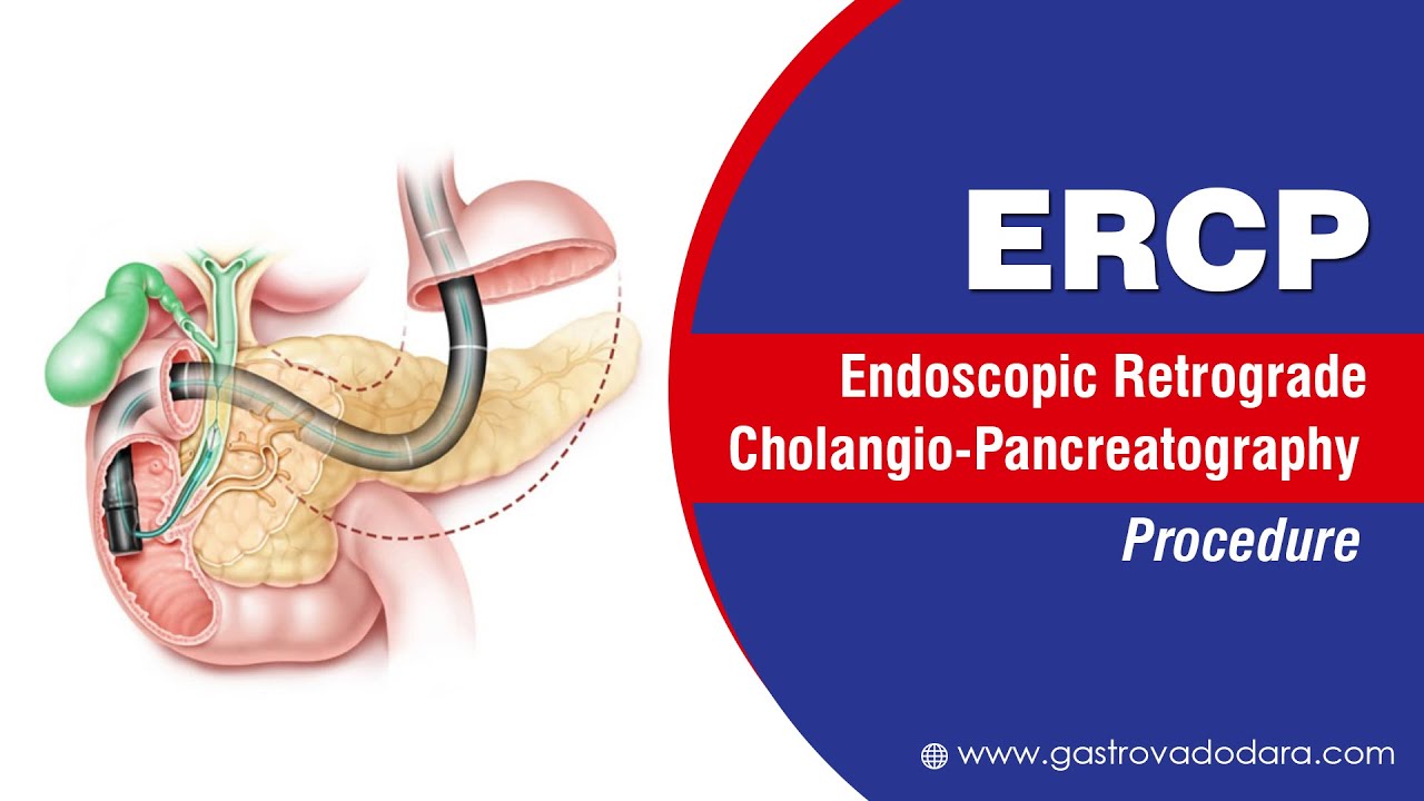 Understanding ERCP Procedure by Dr. Chirayu Chokshi | ERCP For Multiple ...