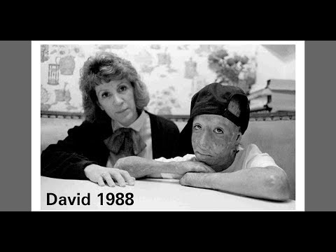 David 1988 ~ David Rothenberg set on fire by father in 1983