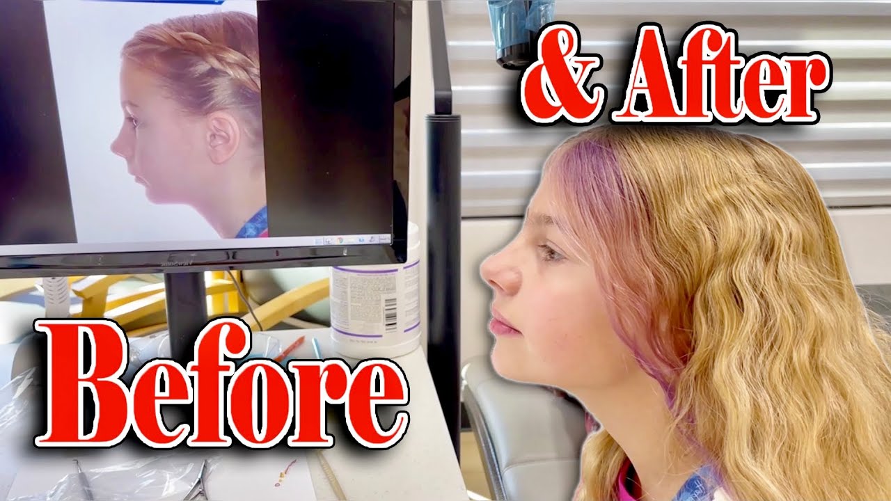 Savannah's Jaw Is Changing! Braces Before And After! - YouTube