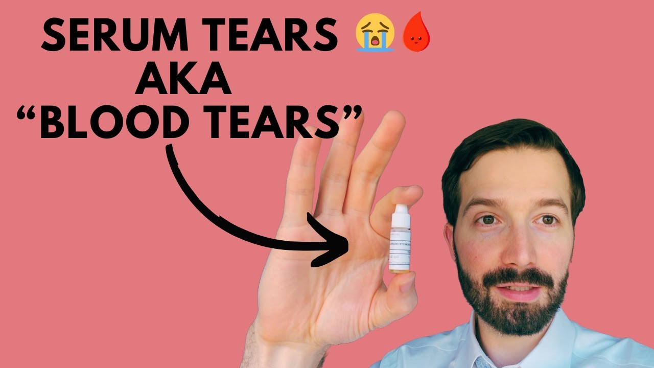 Serum Tears: Steps for getting the overall best dry eye treatment (eye ...