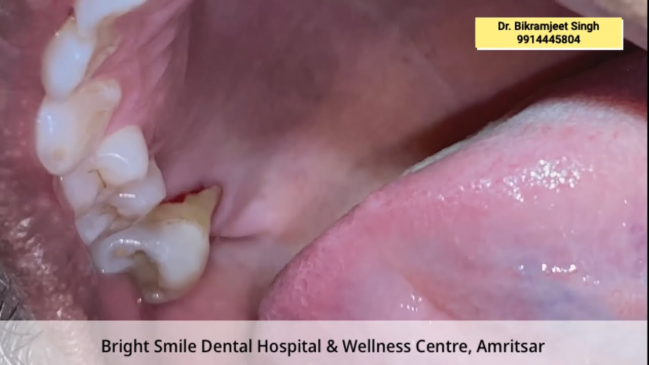 What happens after getting your tooth extracted from dentist? | Supra ...