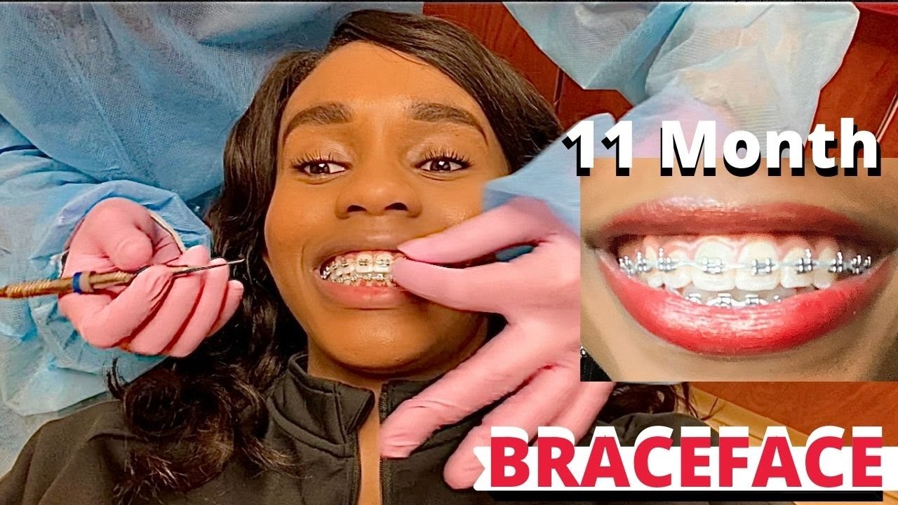 11 MONTH BRACES UPDATE - YouTube