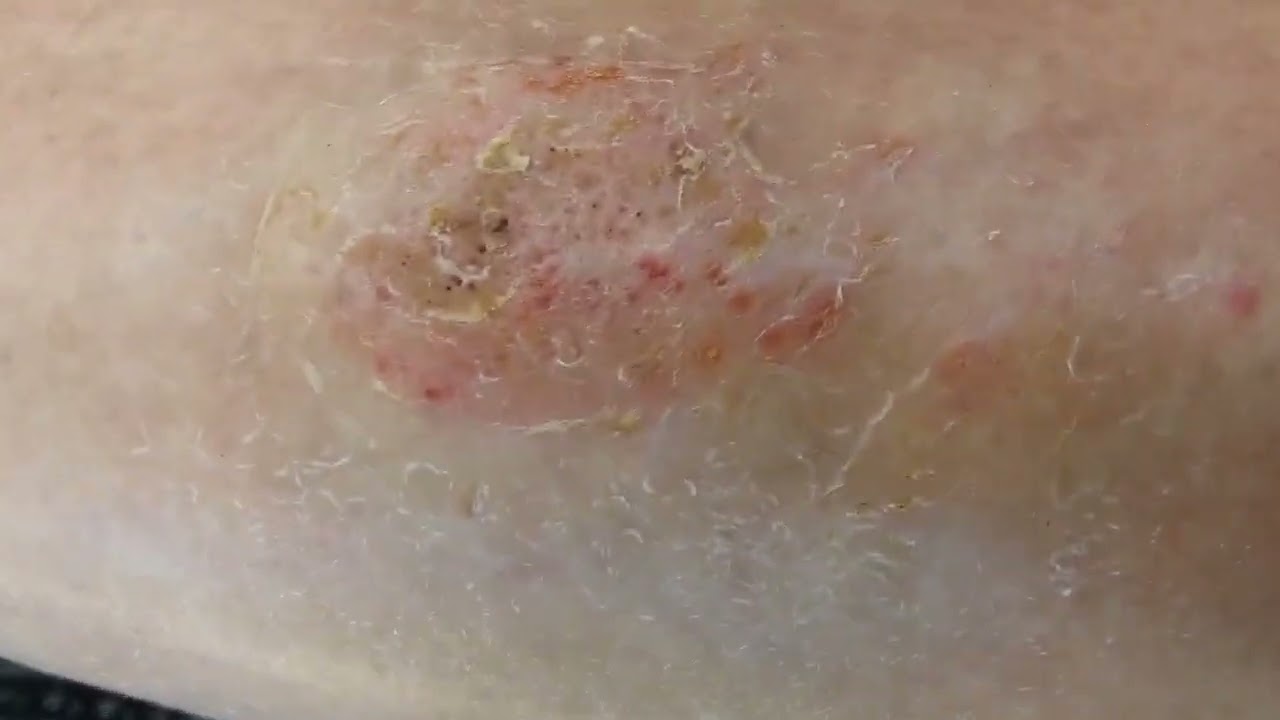 Itchy Arms And Legs Due To Heat Rash And Hives By Mind Control Weapon itchy-arms-and-legs-due-to-heat-rash-and-hives-by-mind-control-weapon