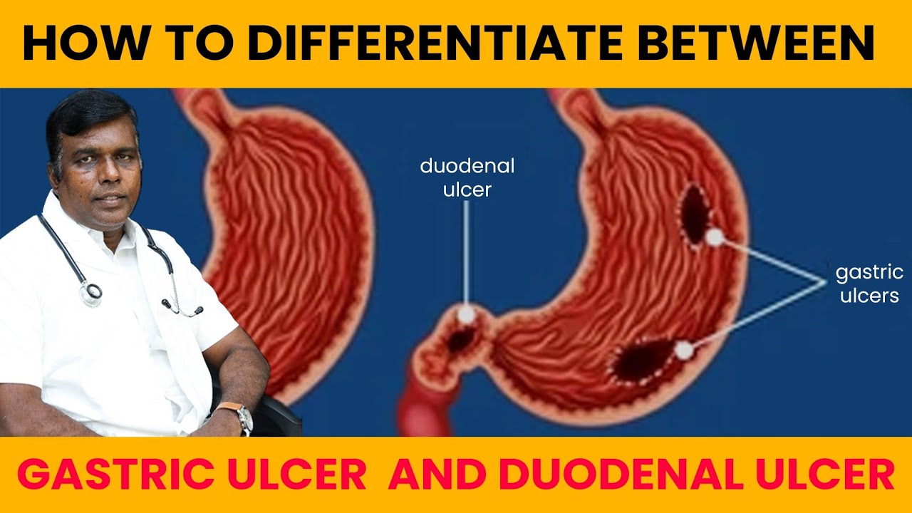 "How to Identify Gastric vs. Duodenal Ulcers Effectively" | Dr ...