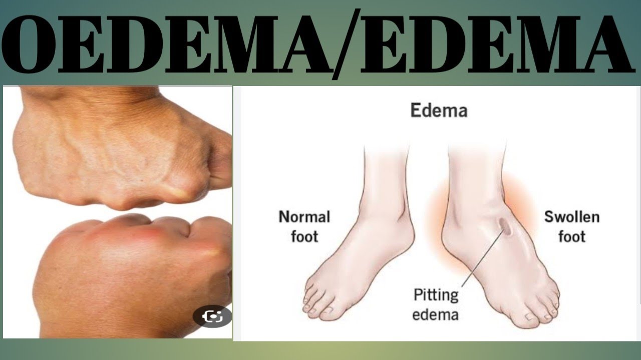 !! EDEMA!! DEFINITION!! TYPES!! CAUSES!! SYMPTOMS!! TREATMENT!! - YouTube