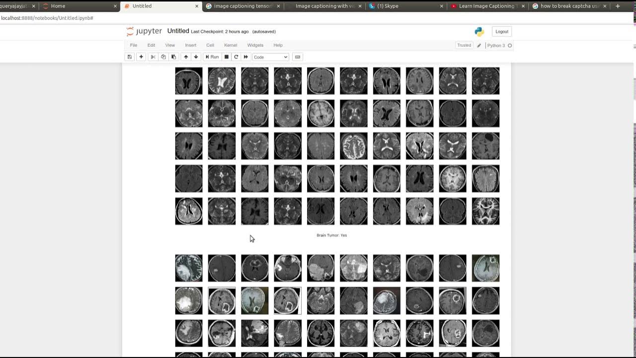 Implementation of Brain Tumor Detection & Classification using CNN TensorFlow | Python Tutorial ...