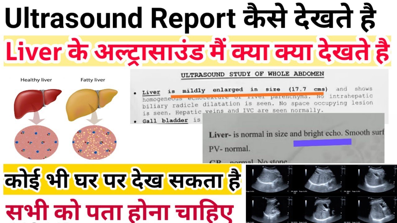 Ultrasound Report कैसे देखते है - Liver ultrasound report - रिपोर्ट मैं ...