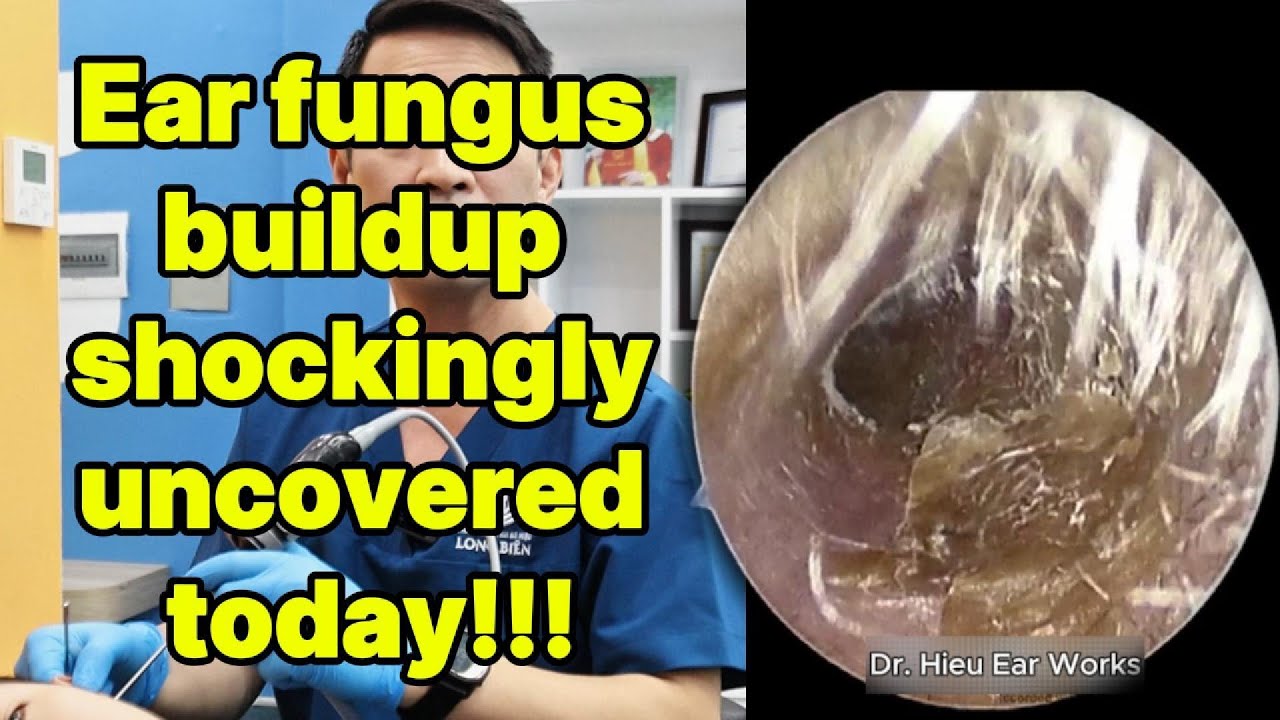 Ear fungus buildup shockingly uncovered today | ear cleaning | ASMR ...