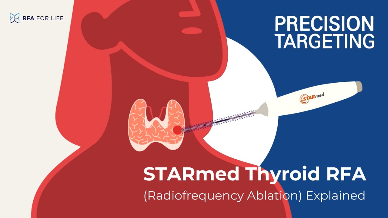 STARmed Thyroid RFA(Radiofrequency Ablation) Explained - YouTube