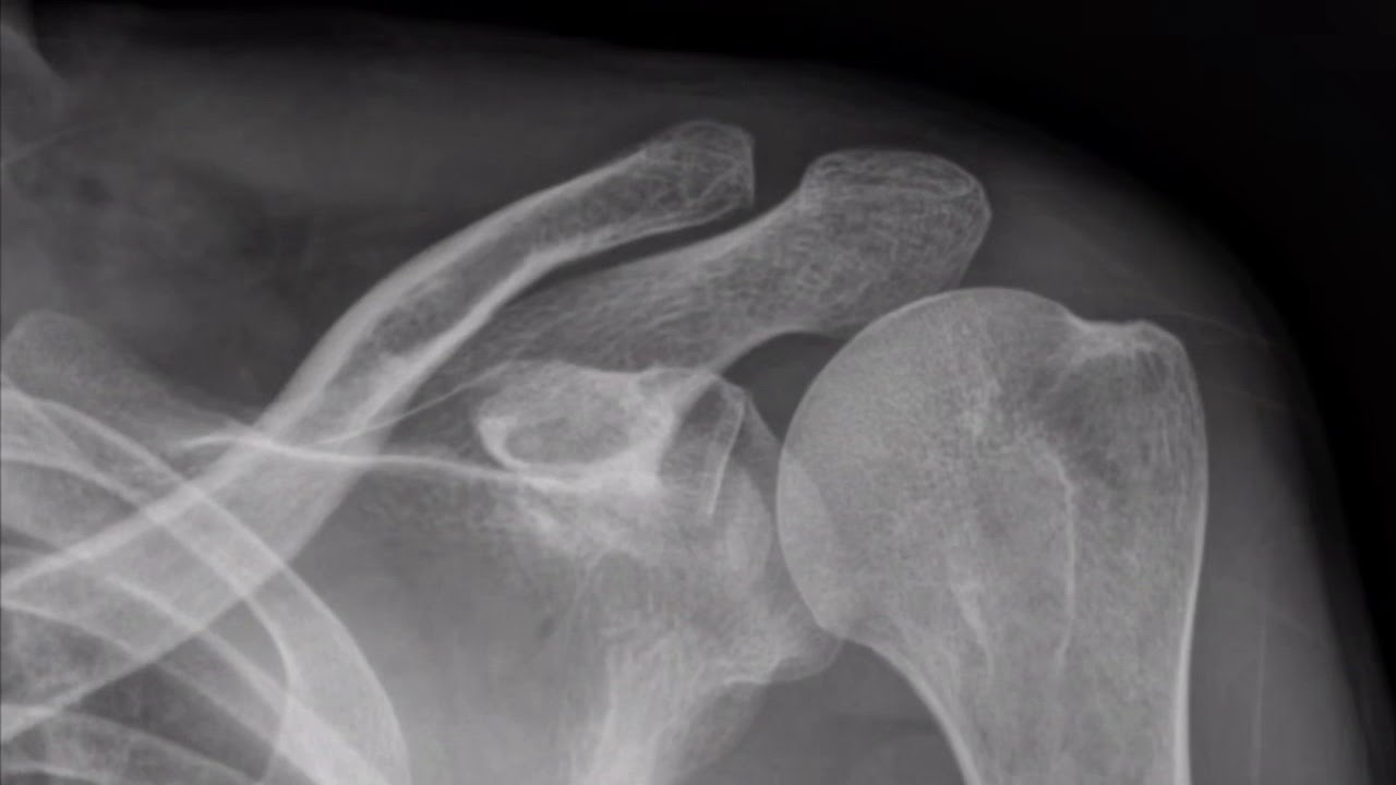 Arthroscopic Assist Coracoid Fracture Fixation - YouTube