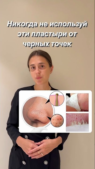 Никогда не используй пластыри от черных точек #уходзакожей #акне - YouTube