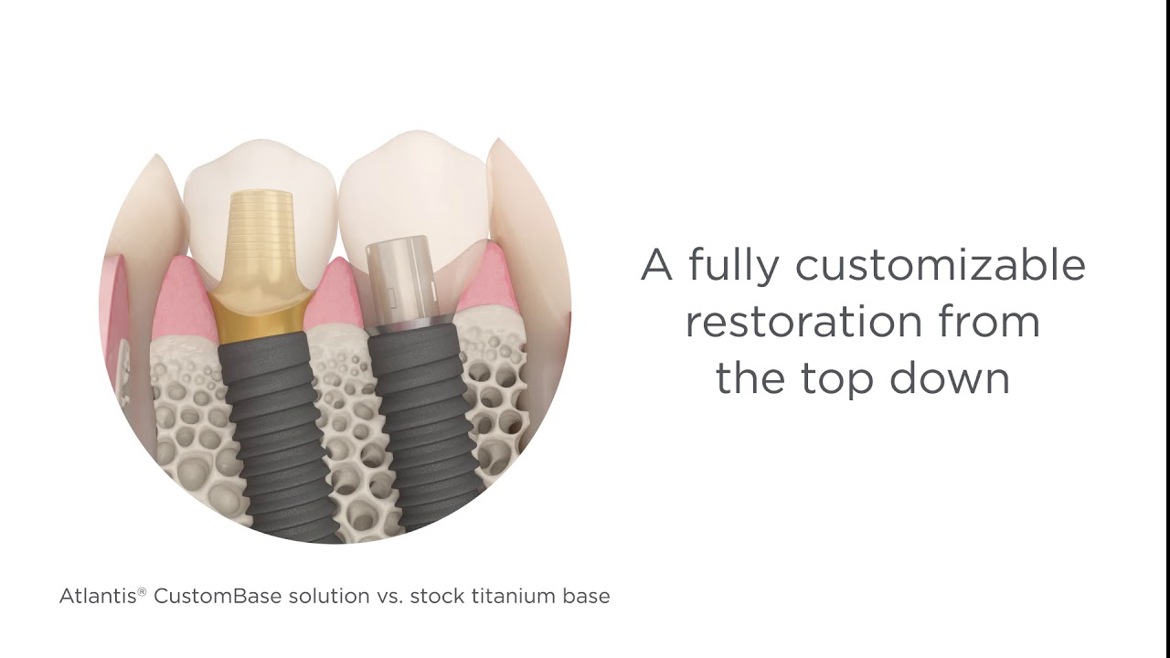 Atlantis CustomBase solution | Dentsply Sirona - YouTube