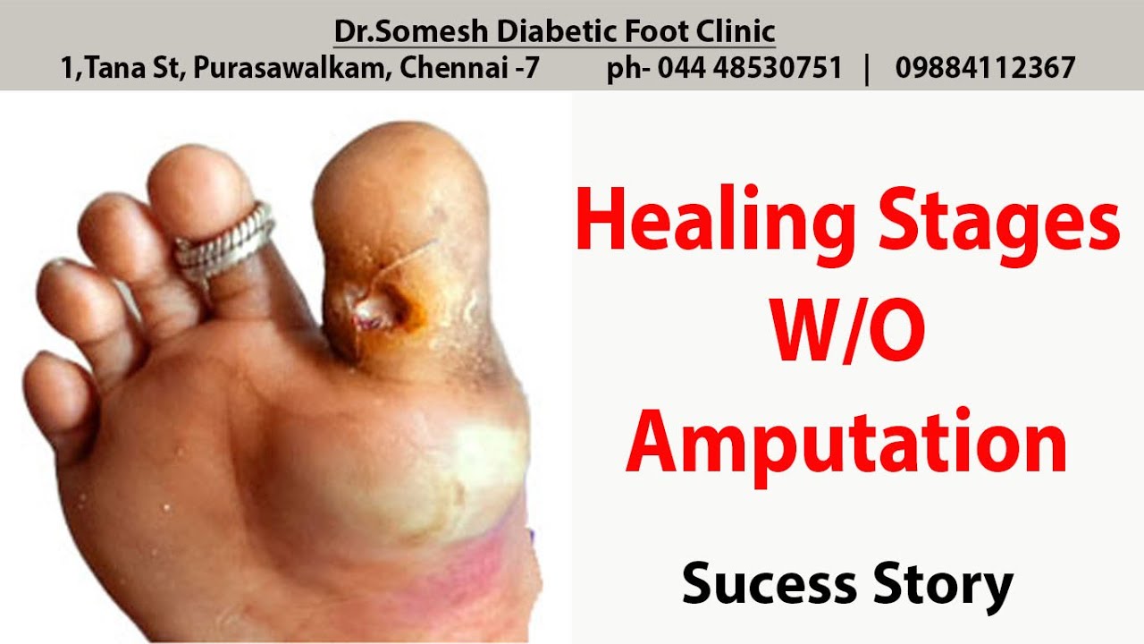 #ToeInfection healing stages W/O amputation - Podiatrist Chennai - YouTube