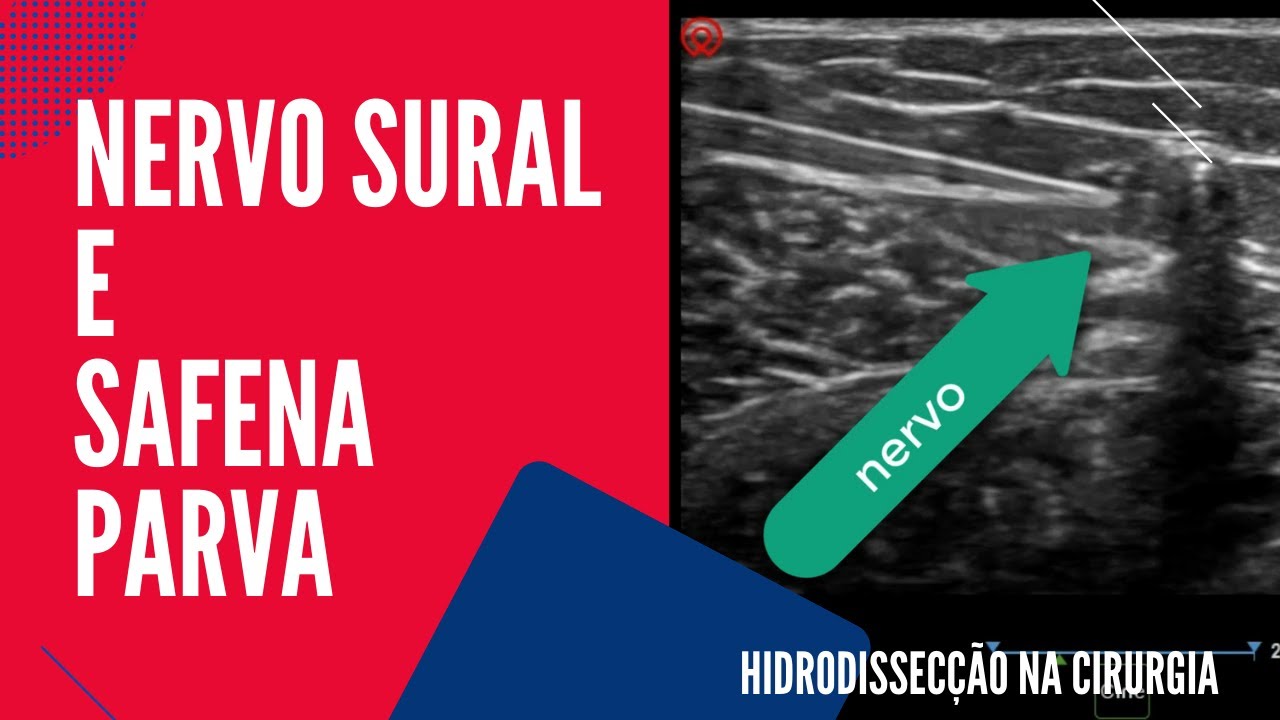 Nervo sural e safena parva - Técnica de Hidrodissecção na Cirurgia ...