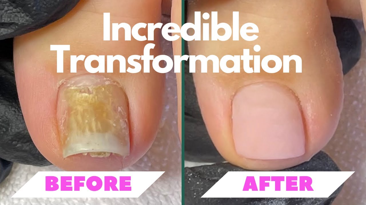 Incredible Toenail Transformation with NanoFlex by Fuzion! - YouTube