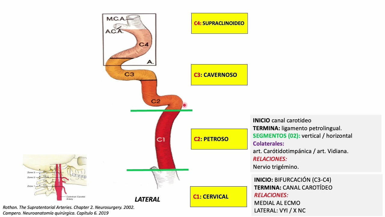 Modelo De Arteria Carotida Interna