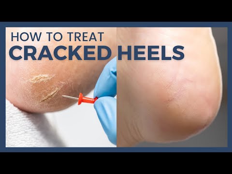 How To Treat Cracked Heels - Reduce Callus and Fissures