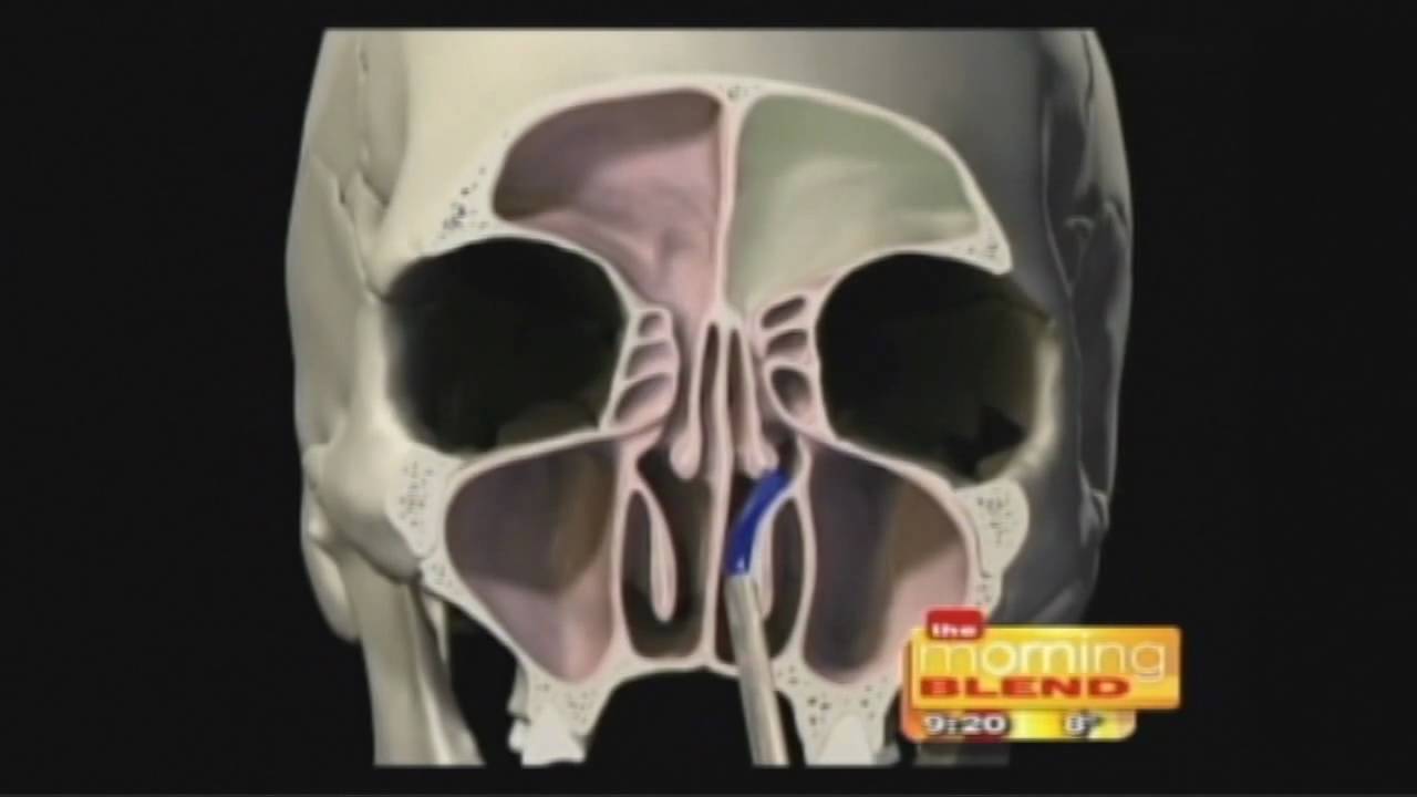 Balloon Sinuplasty Patient Perspective - YouTube