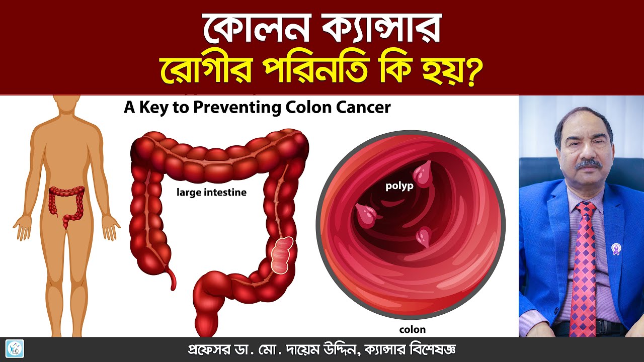 নীরব ঘাতক কোলন ক্যান্সার, লক্ষণ, কারণ ও প্রতিকার - Prof. Dr. Md Dayem Uddin - YouTube