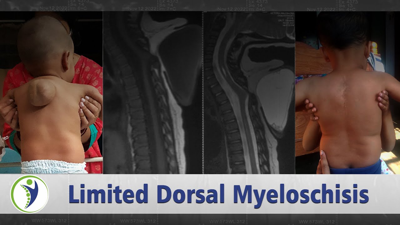 Spinal Dysraphism - Limited Dorsal Myeloschisis (LDM) - YouTube